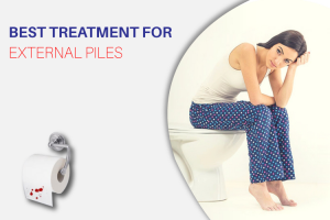 Best Treatment for External Hemorrhoids – Symptoms and Treatment